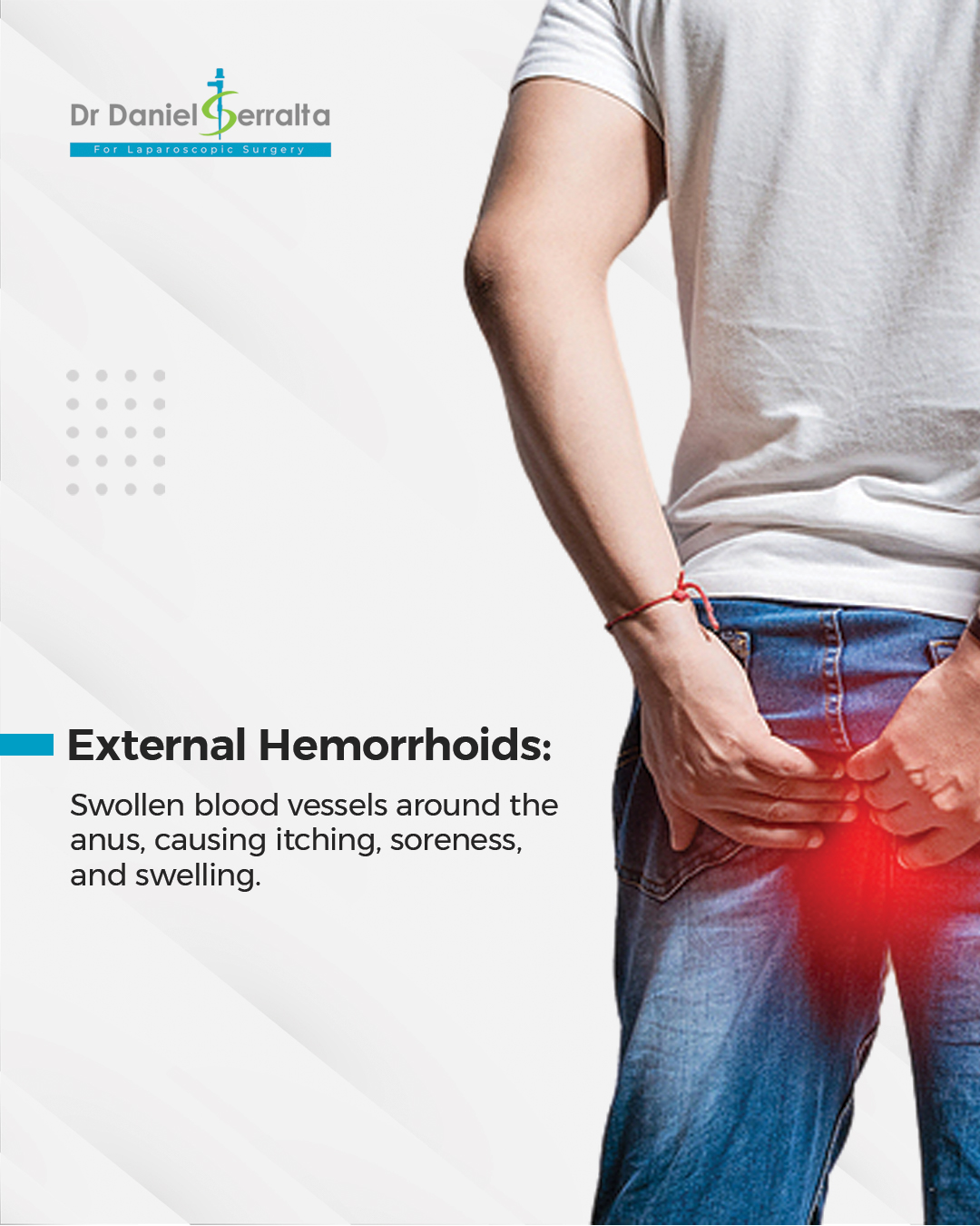 Hemorrhoids Treatment In Dubai | Piles Doctor | Dr. Serralta